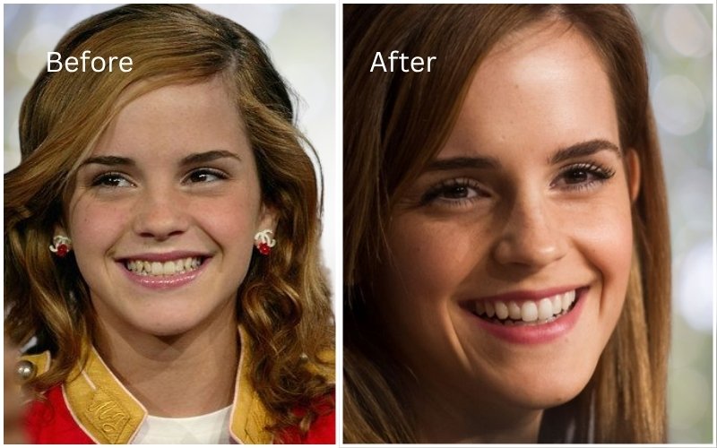 Emma Watson Teeth The Science Behind Her Smile