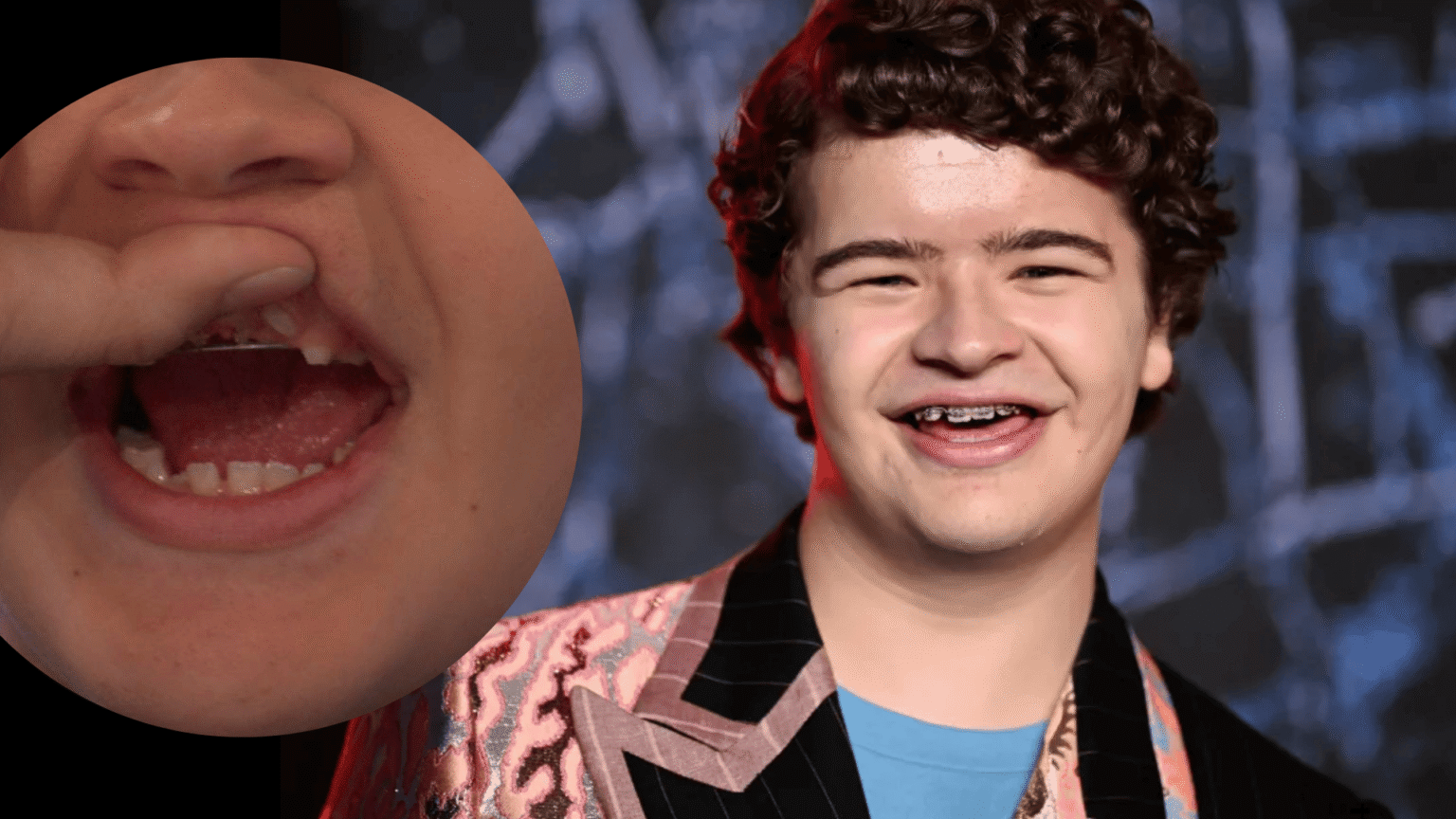 Gaten Matarazzo Teeth: Science Behind His Stranger Things Smile