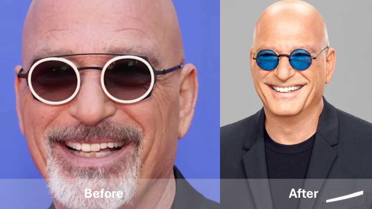 Howie Mandel Dental Veneers: Celebrity Smile Science